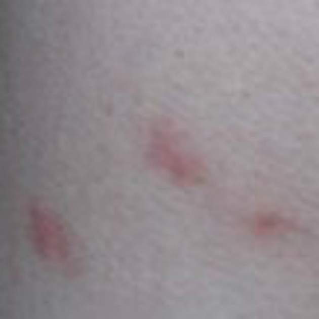 V čom je blcha ľudská odlišná od zvieracej? - ZDRAVIE.sk