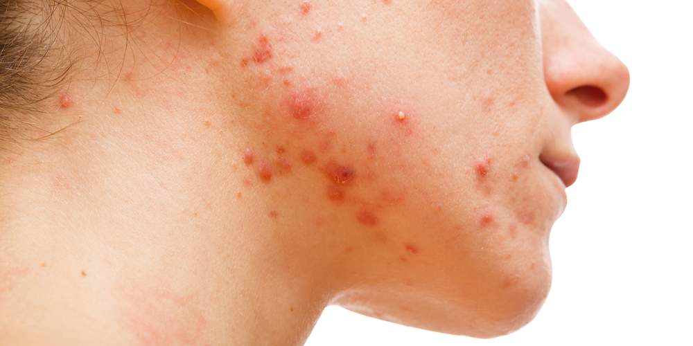 Akné - ZDRAVIE.sk
