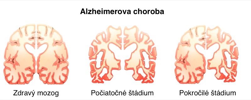 Alzheimerova choroba - Alzheimerova choroba - mozog (1 / 2) - Galéria ...