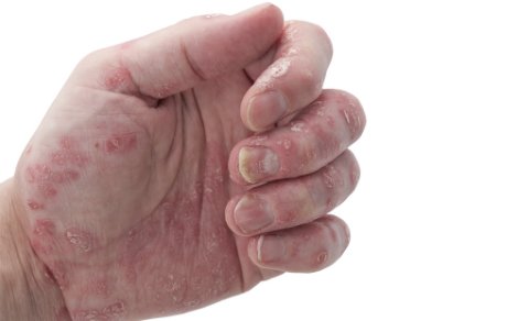 Psoriáza sa týka nás všetkých - ZDRAVIE.sk