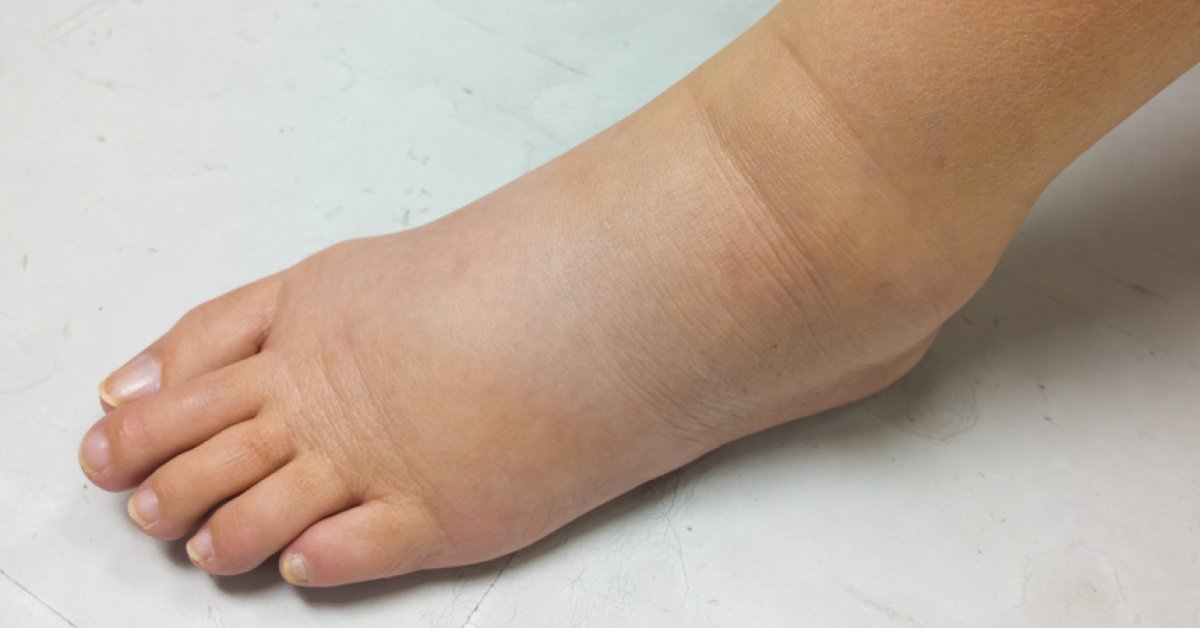 Lymfedém - ZDRAVIE.sk