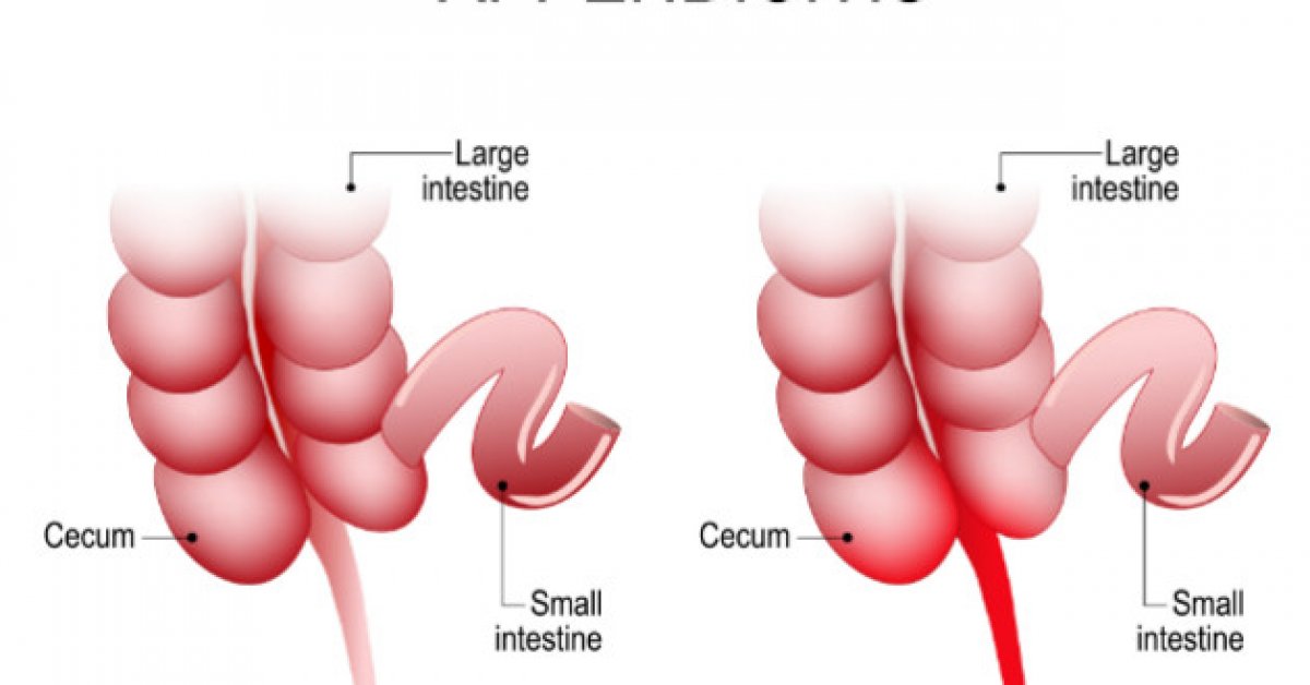 Slepé črevo - Zdravé verzus zapálené slepé črevo (3 / 5) - Galéria ...