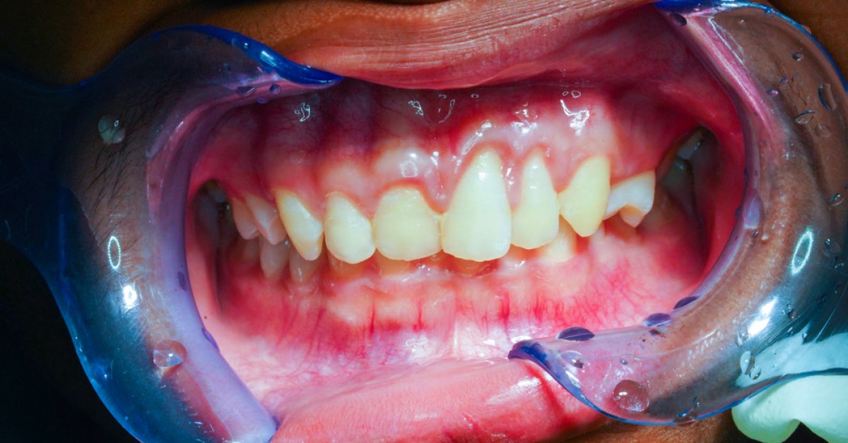 Paradentóza alebo parodontitída - jeden z najčastejších problémov u ...