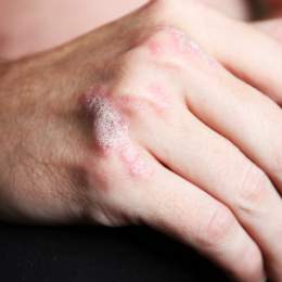 Diagnóza L40 - Psoriáza - ZDRAVIE.sk